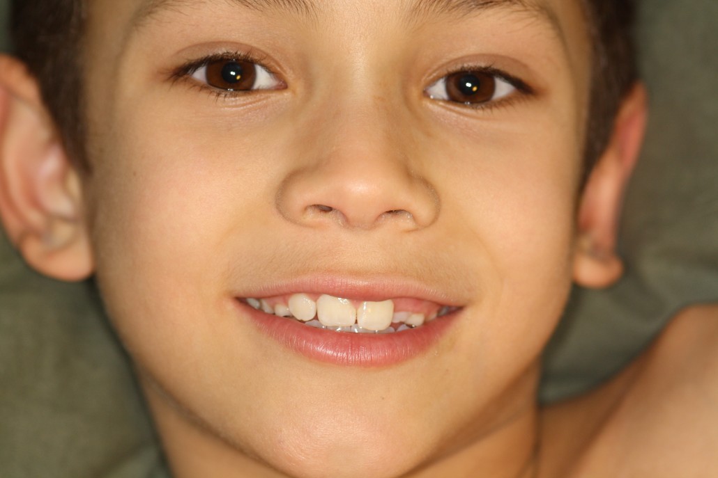 occlus-o-guide Archives - Mandanas Dental