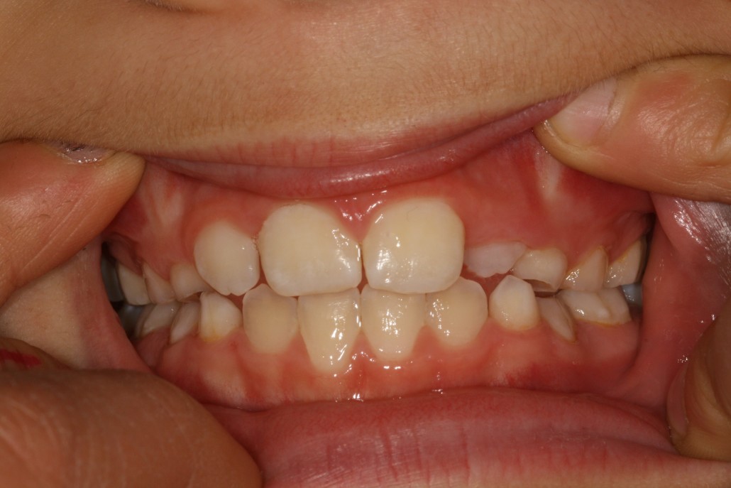occlus-o-guide Archives - Mandanas Dental