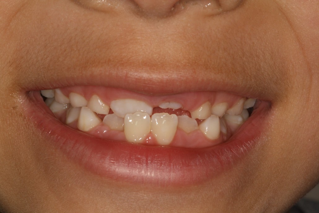 occlus-o-guide Archives - Mandanas Dental